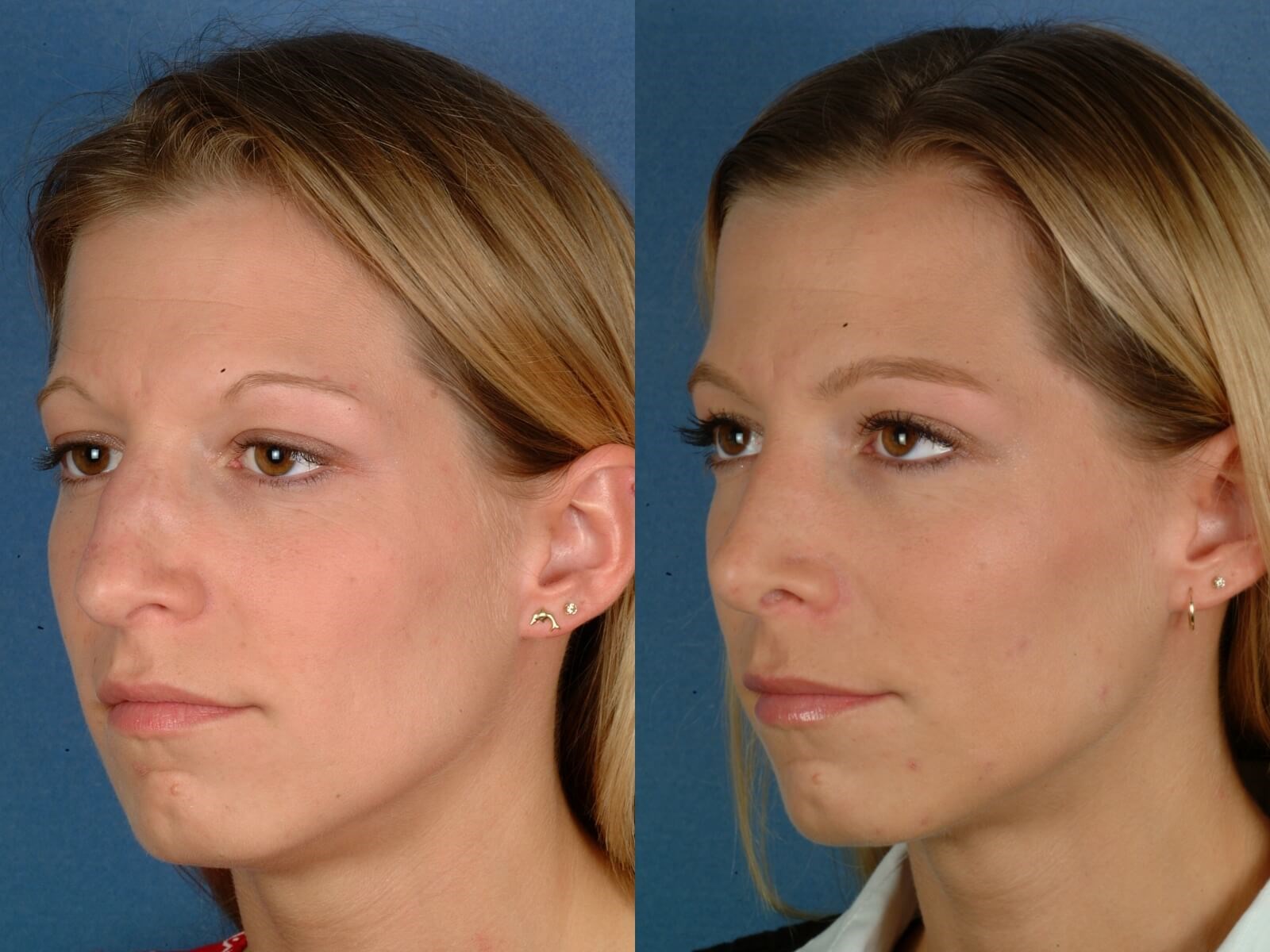 Revision Rhinoplasty with Septal Perforation Repair | Case 84421